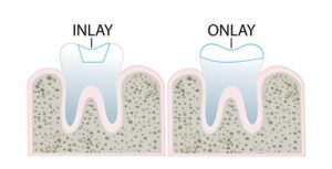 Inlays and Onlays – Biddeford Family Dentistry